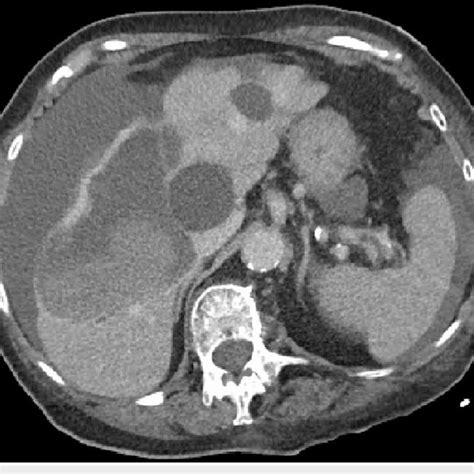 Ct Abdomen Showing Moderate Hemoperitoneum Along With Multiple Bleeding