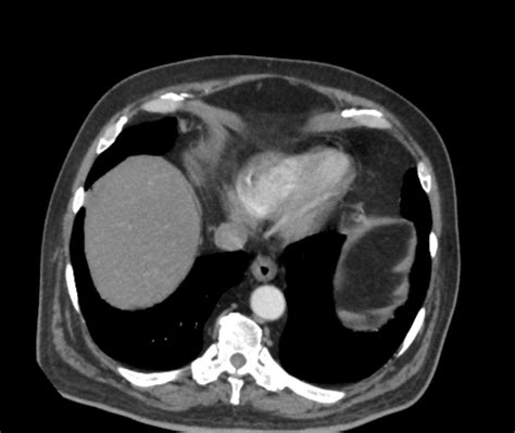 Appendicular Abscess Radiopaedia 54256 60459 A Nc Commons