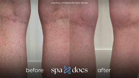 Hyperpigmentation Removal Spa Docs Expert Beauty Treatments Lincoln Ne