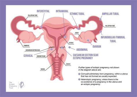 What Is An Ectopic Pregnancy The Ectopic Pregnancy Trust