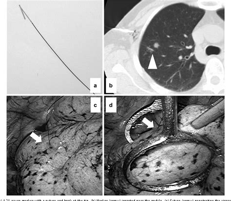Figure 1 From Preoperative Localization Of Small Peripheral Pulmonary Nodules By Percutaneous