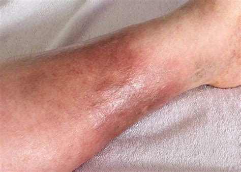 Cellulitis Treatment