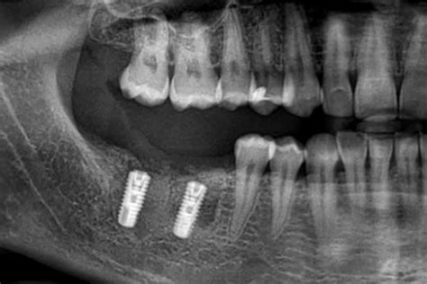 Immediate Implantation In Extraction Sockets With Periapical Pathology