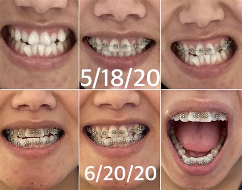 Got My Bottom Braces Put On Today One Month Update Rbraces