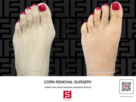 Minimally Invasive Corn Removal Surgery At Foot First Podiatry — Foot