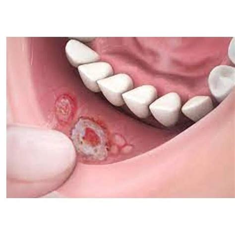 Candid Mouth Paint For Oral Thrush Treatment For Kills Fungal 25gm Ebay