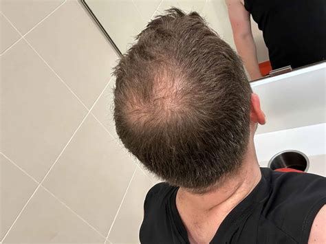 Understanding Double Hair Whorl Patterns And Significance