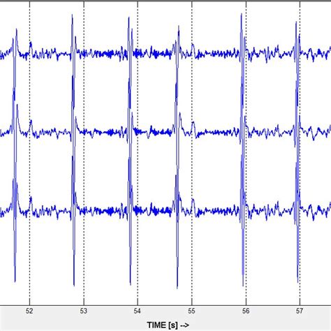 Pdf Processing Holter Ecg Signal Corrupted With Noise Using Ica For Qrs Complex Detection