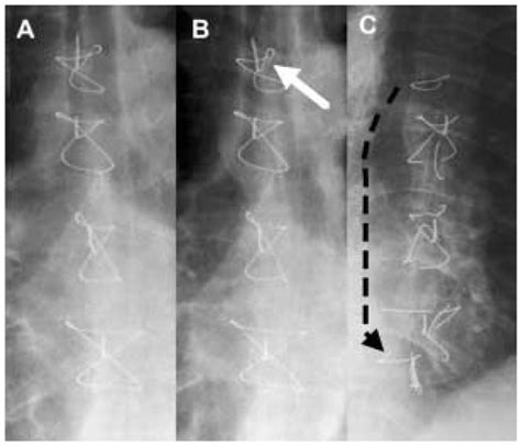 Migration Of Fractured Sternal Wires After Cabg In A Smoker