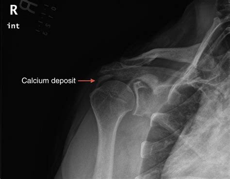 Evaluation And Nonsurgical Management Of Rotator Cuff Calcific
