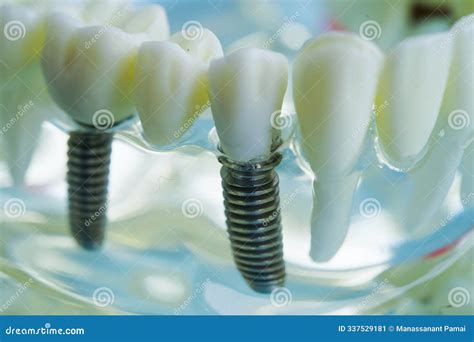 Dental Implant Artificial Tooth Roots Into Jaw Root Canal Of Dental