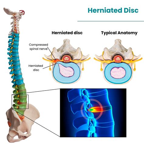 Vertebrae And Disc Anatomy