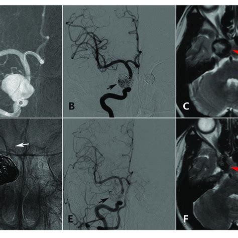 A 28 Year Old Woman With A Double Cavernous Segment Ica Aneurysm The