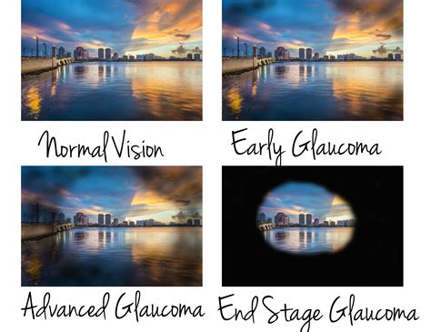 Glaucoma Vision