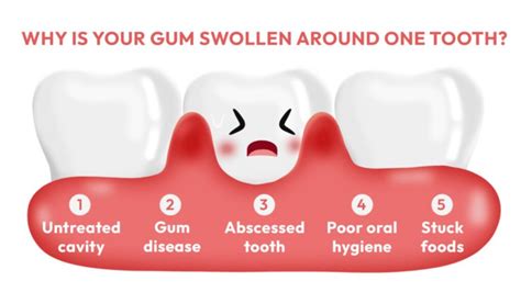 Gum Swelling And Bleeding Gums Gingivitis Treatment Aries Oro Facial Vadodara