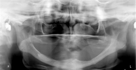 Impacted Tooth Dr Gs Toothpix