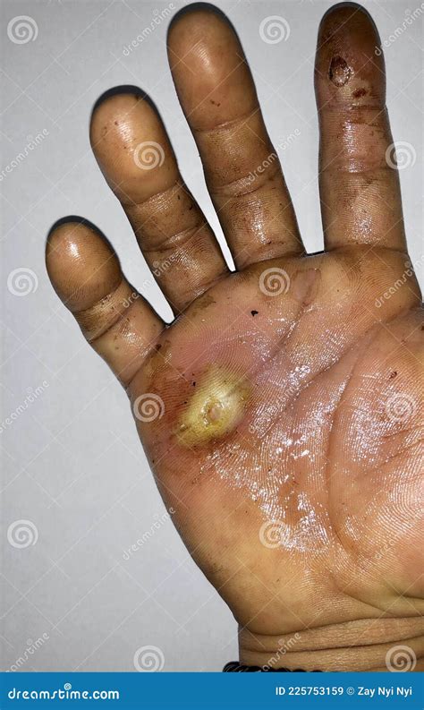 Abscess With Surrounding Cellulitis Or Staphylococcal Streptococcal Skin Infection At Hand Of