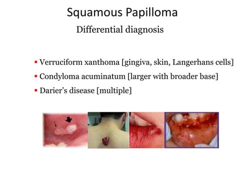 Papillary Lesions Pdf