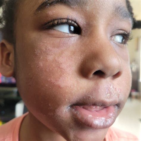 What We Learned About Pediatric Urticaria Hives And Food Allergies