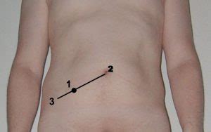 Apendicitis Aguda ¿ecografía Abdominal Como Primera Prueba Diagnóstica