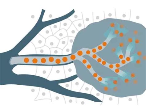 Targeted Victory Mastering Chemo Embolization In Cancer Treatment