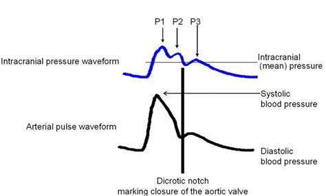 Figure 1 From Intracranial Pressure Waveform Analysis During Rest And Suctioning Semantic Scholar