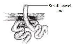 Ileostomy Care Maher A Abbas Md Proctologist Colorectal Surgeon