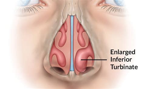 Surgeons Guide Septoplasty And Turbinate Reduction