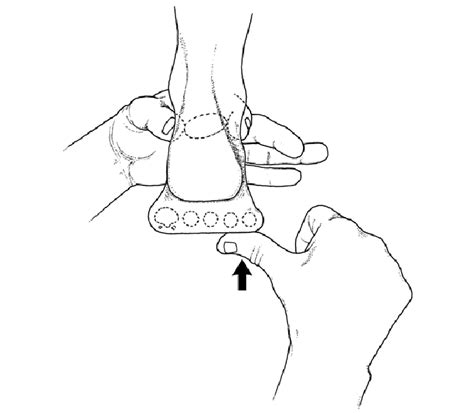 중족근골 관절midtarsal Joint의 잠김locking 위치를 찾 는 방법 한 손으로 족근골 두부tarsal