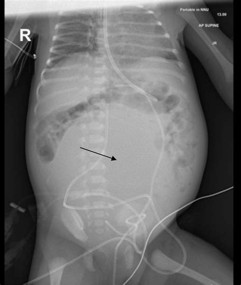 Rare Case Of Pseudohypoaldosteronism In A Neonate Secondary To Congenital Hydrometrocolpos Bmj