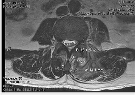 Mri Axial T2 Sequence Showing Multifocal Left Paraspinal Abscesses Download Scientific
