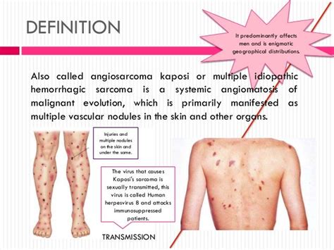 Kaposis Sarcoma