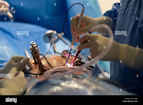 Doctors Performing Spine Surgery Using Neuronavigation Computer Assisted Technology System Stock