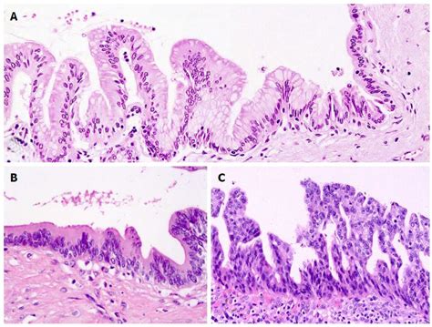 Pathological Features And Diagnosis Of Intraductal Papillary Mucinous