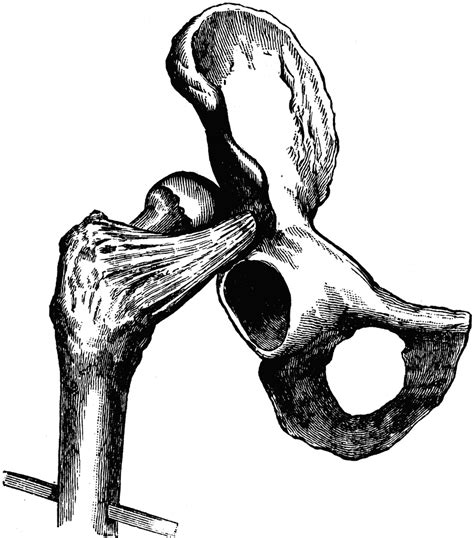 Free Dislocation Cliparts Download Free Dislocation Cliparts Png