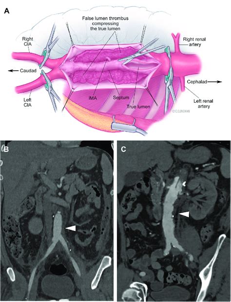 A Illustration Of Open Aortic Septectomy After Lateral Aortotomy Download Scientific Diagram