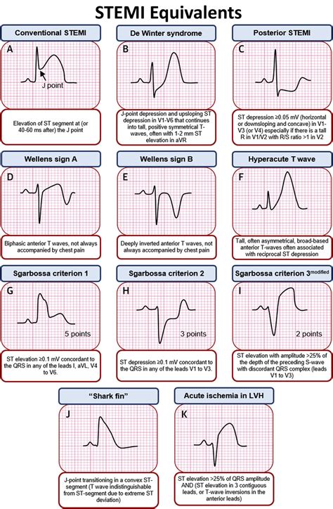 Stemi St Elevation Myocardial Infarction Diagnosis 48 Off