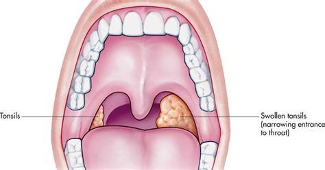 Free Lsat Help Have You Gotten Your Tonsils Removed