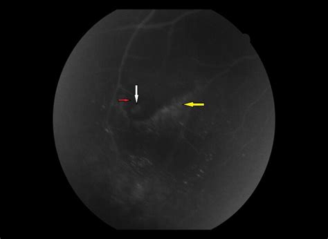 Fa Image Of Re Red Arrow Depicts Hypo Fluorescence Corresponding To The Download Scientific