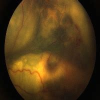 Retina Detect Object Detection Dataset By Detect Cells