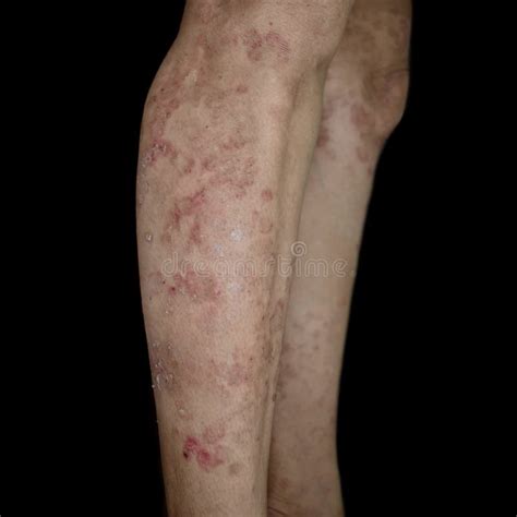 Fungal Infection Called Tinea Corporis In Leg Of Asian Woman Stock