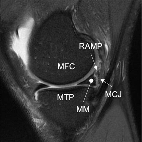 Magnetic Resonance Imaging Mri Classification Of Ramp Lesions Download Scientific Diagram