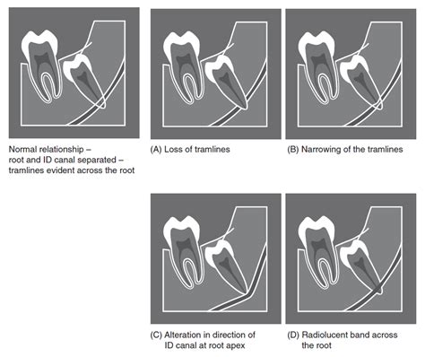 Interpretasi Radiografi Gigi Impaksi Molar Tiga Rahang Bawah Bagian 2
