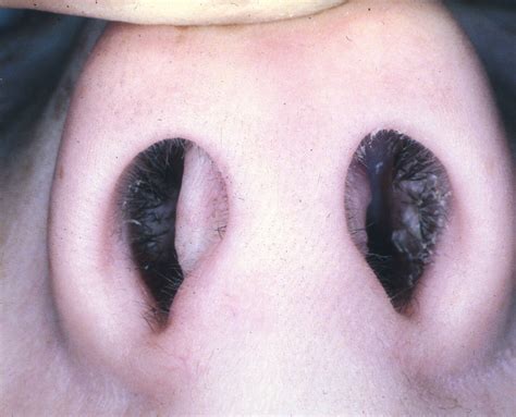 Deviated Septum Nose Job Uk Dawne Archie