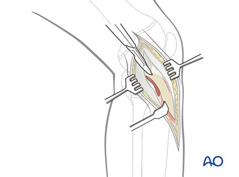 Anterolateral Approach To The Proximal Tibia