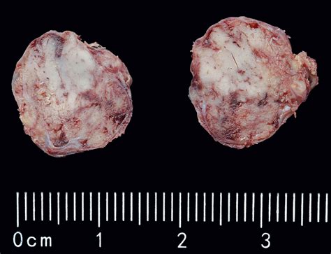 Pathology Outlines Parathyroid Tissue Parathyroid Adenoma And Variants