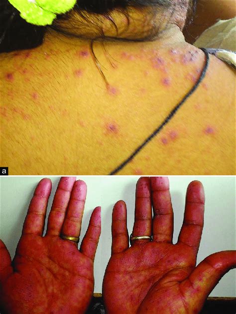 Ppd Induced Erythema Multiforme Like Lesions Over A Upper Back And