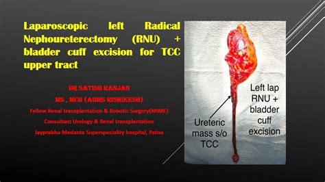 Laparoscopic Radical Nephroureterectomy Rnu Bladder Cuff Excision