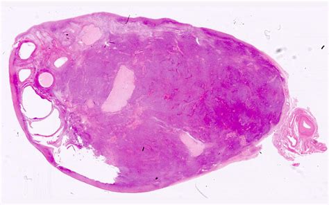 Pathology Outlines Stromal Hyperplasia And Hyperthecosis