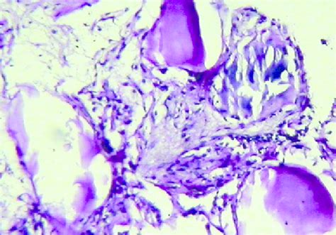Histopathologic Examination Of Lung Shows Interstitial Infiltration By